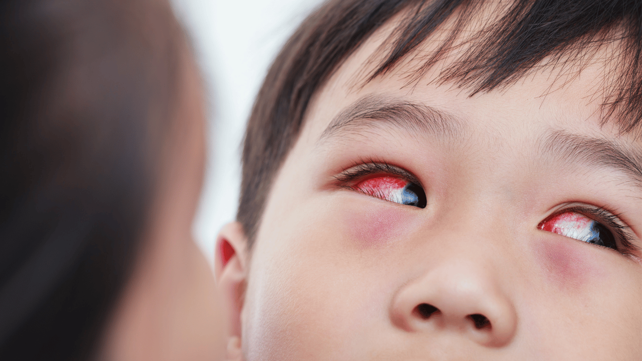 A Guide to Eye Infections in Children in 2025