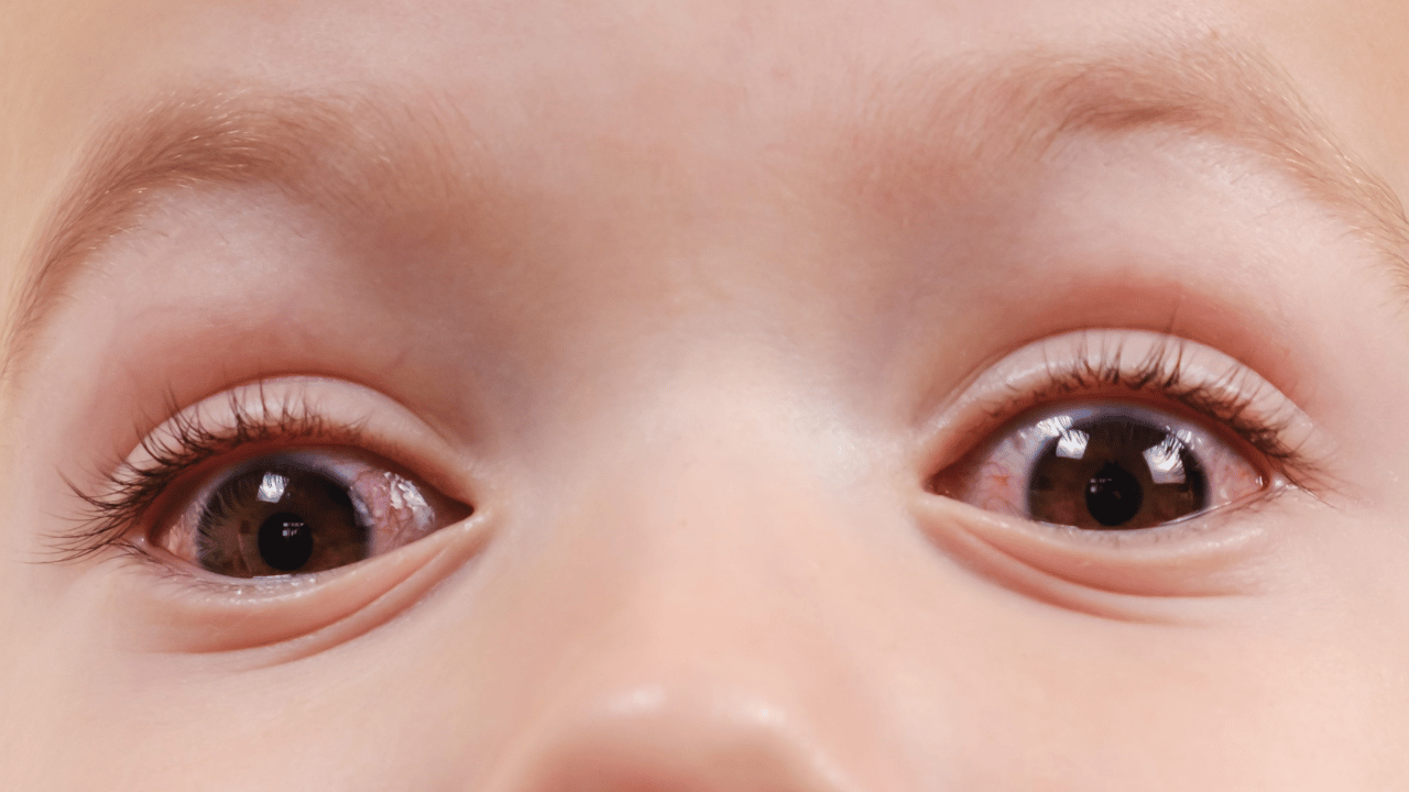 A Guide to Eye Infections in Children in 2025