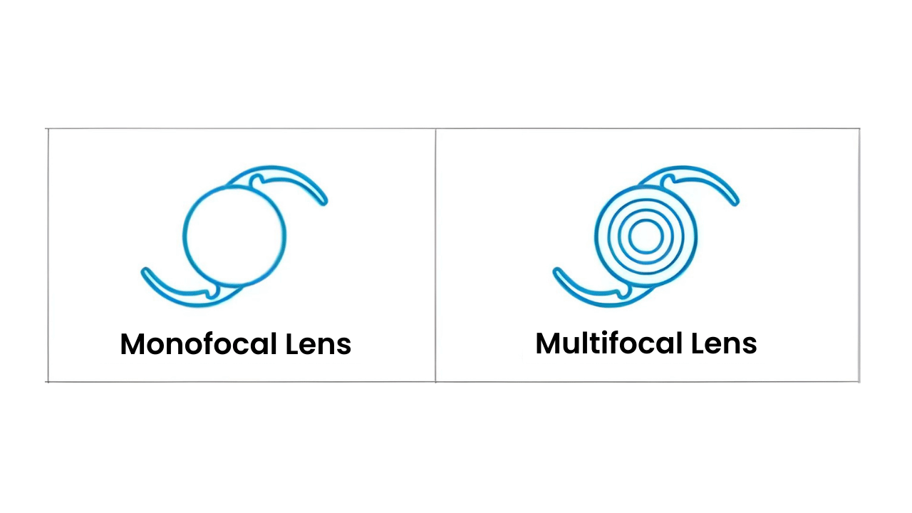 Multifocal IOL: Cost, Benefits & Side Effects Explained 2025