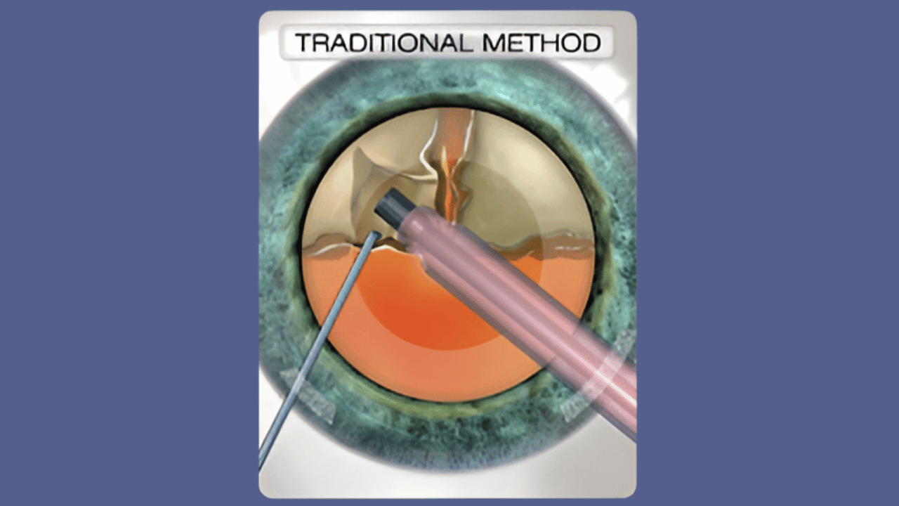 Types of Cataract Surgery in India - Which is right for you?