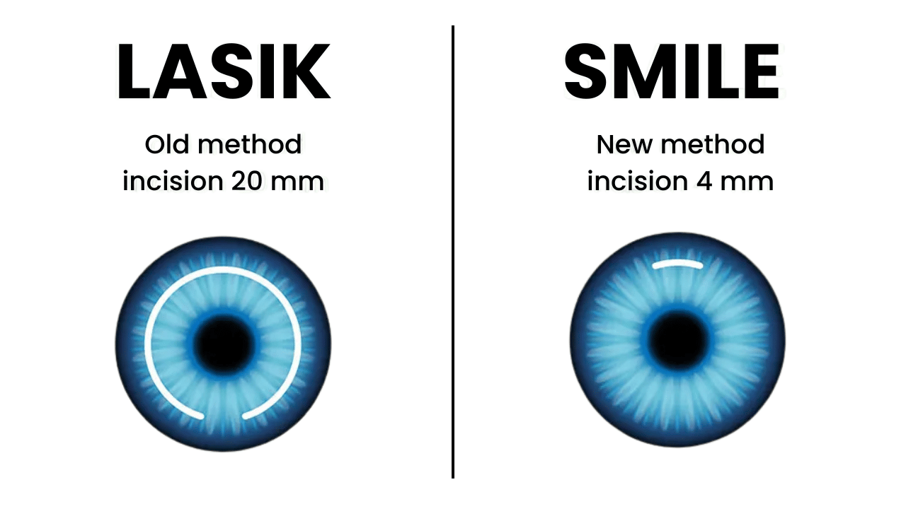 SMILE vs LASIK Eye Surgery: Which One Is Best for You? 2025