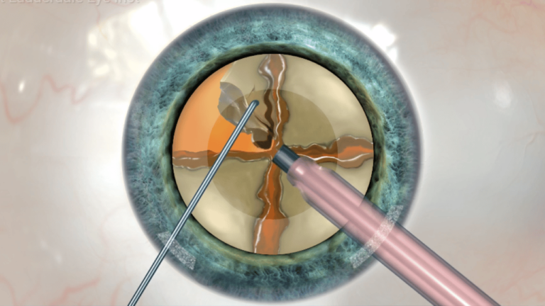 Phacoemulsification vs laser cataract surgery 2025