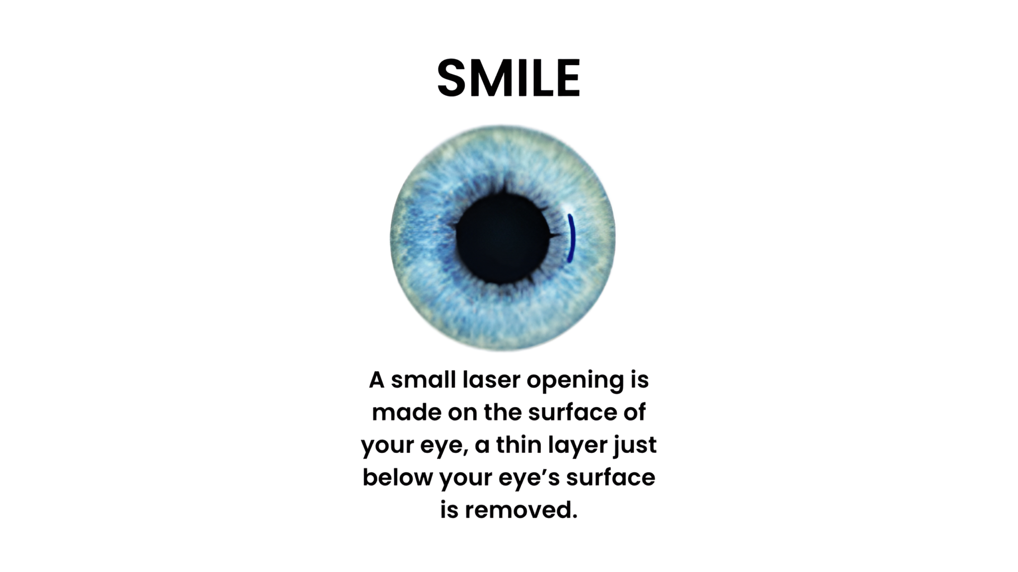 SMILE Eye Surgery Cost in India: Prices & Factors 2025