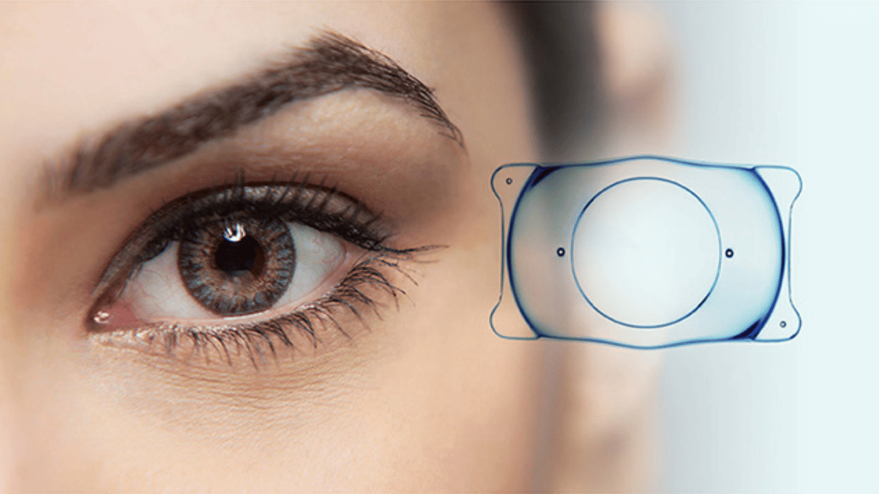 ICL Eye Surgery Cost in India: Pricing & Factors in 2025