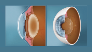 IPCL Surgery: Cost, Benefits & Procedure Explained 2025