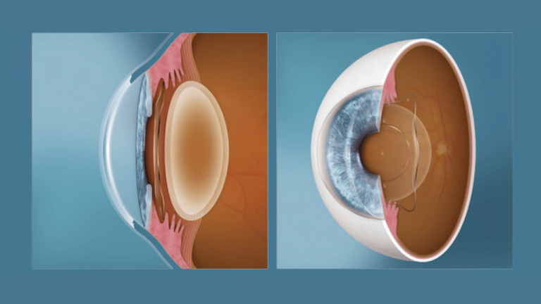 IPCL Surgery: Cost, Benefits & Procedure Explained 2025